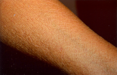 Ichthyosis Fish-Like Scales On Your Skin Can Be Treated