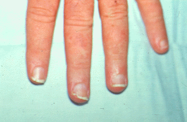 Is Darier Disease Causing a Stubborn Rash On Your Skin?