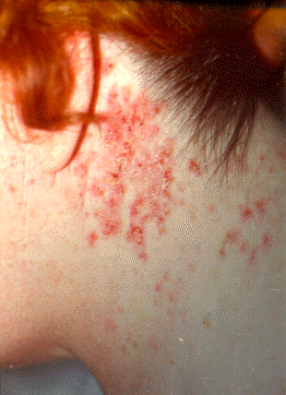 Is Darier Disease Causing a Stubborn Rash On Your Skin?