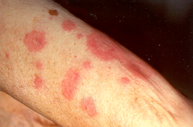 Erythema Multiforme is a Severe, Treatable Allergic Skin Reaction