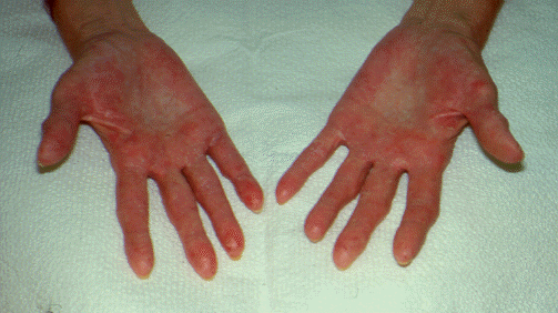 Hand Dermatitis is Common and Can Cause Redness and Irritation